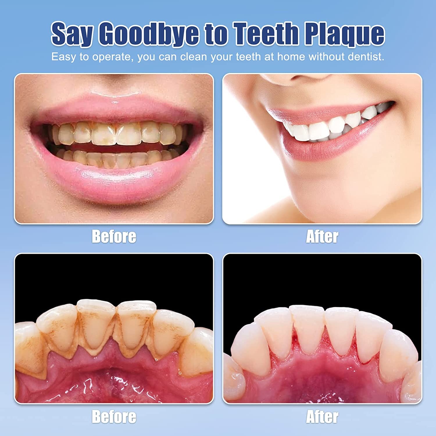 UltraGleam Advanced Ultrasonic Teeth Cleaner, Plaque Remover with LED ...